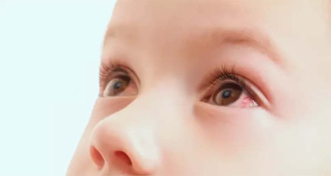 Waspadai Mata Merah pada Anak, Kenali Penyebab, Penanganan dan Cara ...